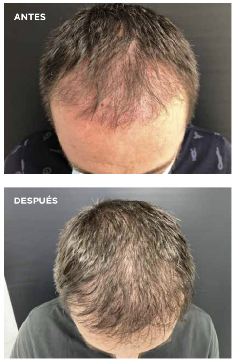 Exosomas. Antes y después. Beneficios. ¿Qué són? - Weglow Clinic